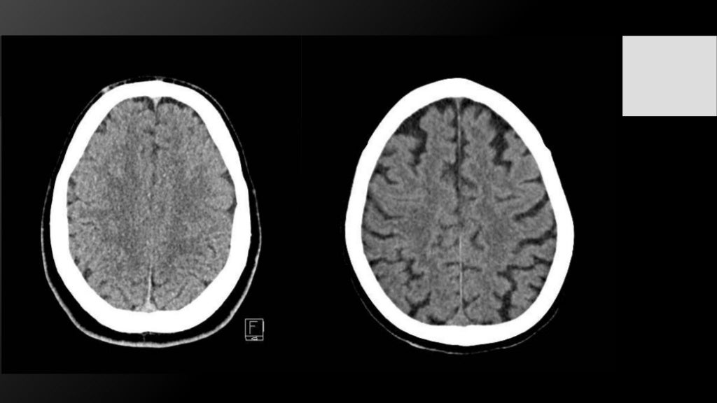 Approach to CT Head Imaging