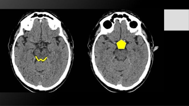 Approach to CT Head Imaging