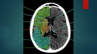CT HEAD ANATOMY.pptx (NORMAL ANATOMY OF CT HEAD | PPTX