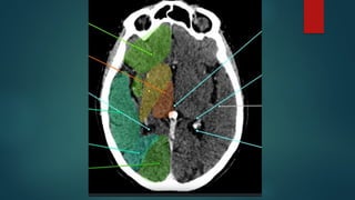 CT HEAD ANATOMY.pptx (NORMAL ANATOMY OF CT HEAD | PPTX