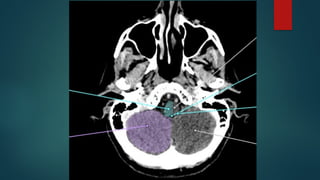 CT HEAD ANATOMY.pptx (NORMAL ANATOMY OF CT HEAD | PPTX