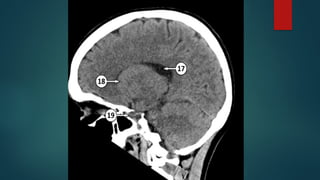 CT HEAD ANATOMY.pptx (NORMAL ANATOMY OF CT HEAD | PPTX