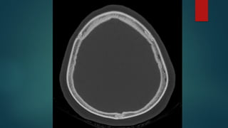 CT HEAD ANATOMY.pptx (NORMAL ANATOMY OF CT HEAD | PPTX