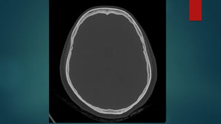 CT HEAD ANATOMY.pptx (NORMAL ANATOMY OF CT HEAD | PPTX
