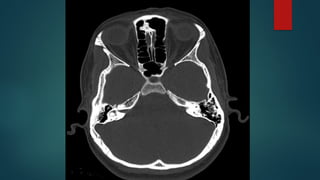 CT HEAD ANATOMY.pptx (NORMAL ANATOMY OF CT HEAD | PPTX
