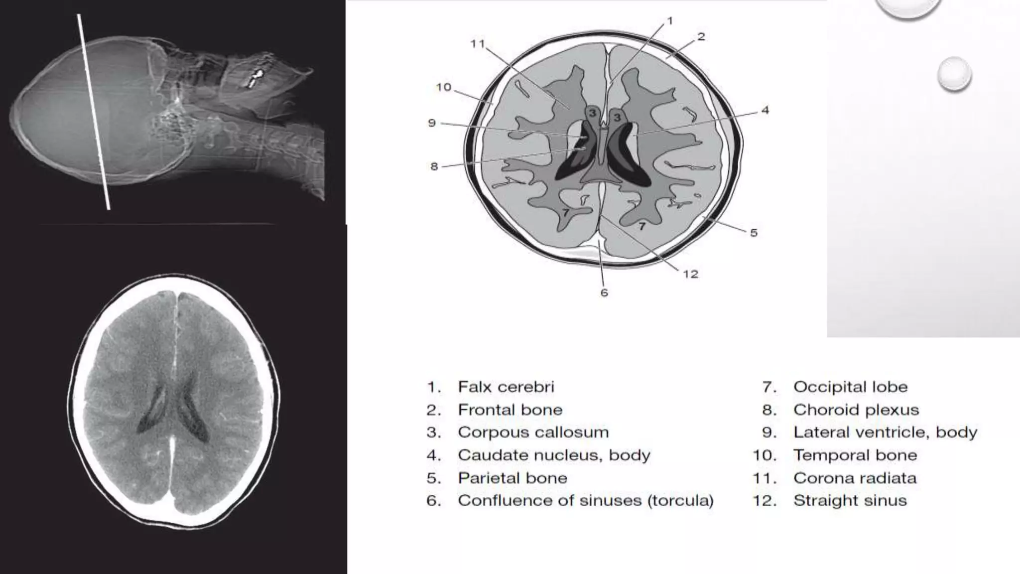 Brain ct scan (anatomy and physiology) | PPTX