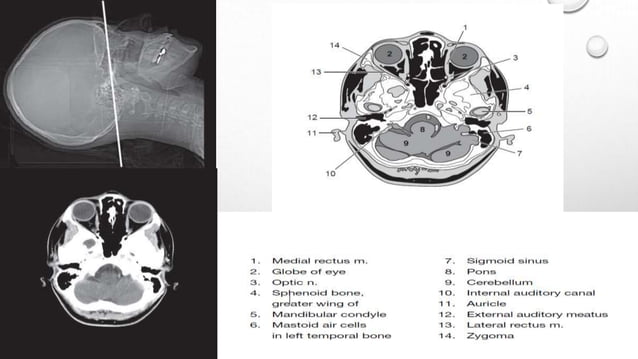 Brain ct scan (anatomy and physiology) | PPT