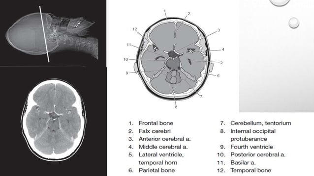 Brain ct scan (anatomy and physiology) | PPT