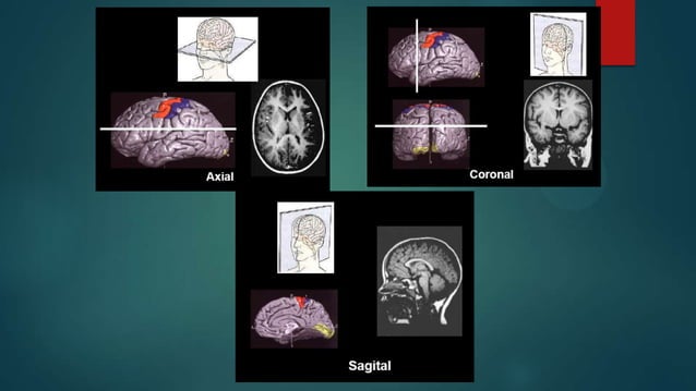Ct brain presentation | PPTX