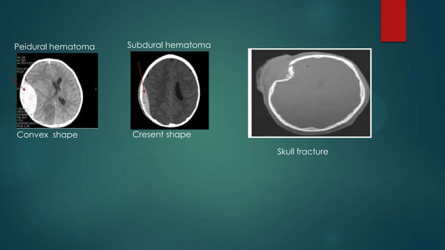 Ct brain presentation | PPTX