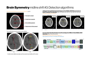 Intracerebral Hemorrhage (ICH): Understanding the CT imaging features | PPT