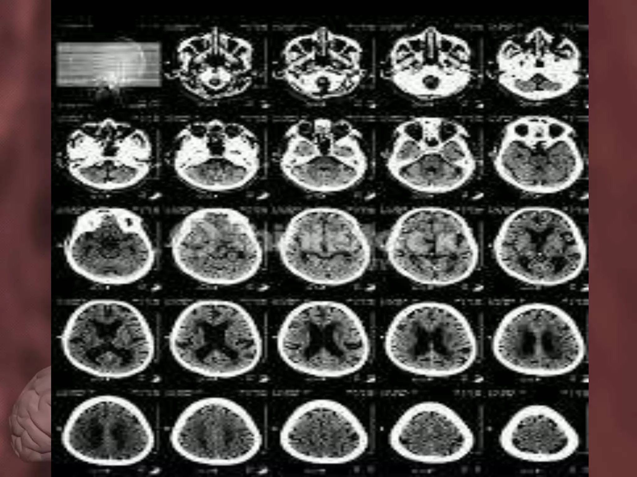 Understanding CT Scan and MRI Brain for Undergraduate Medical Students ...