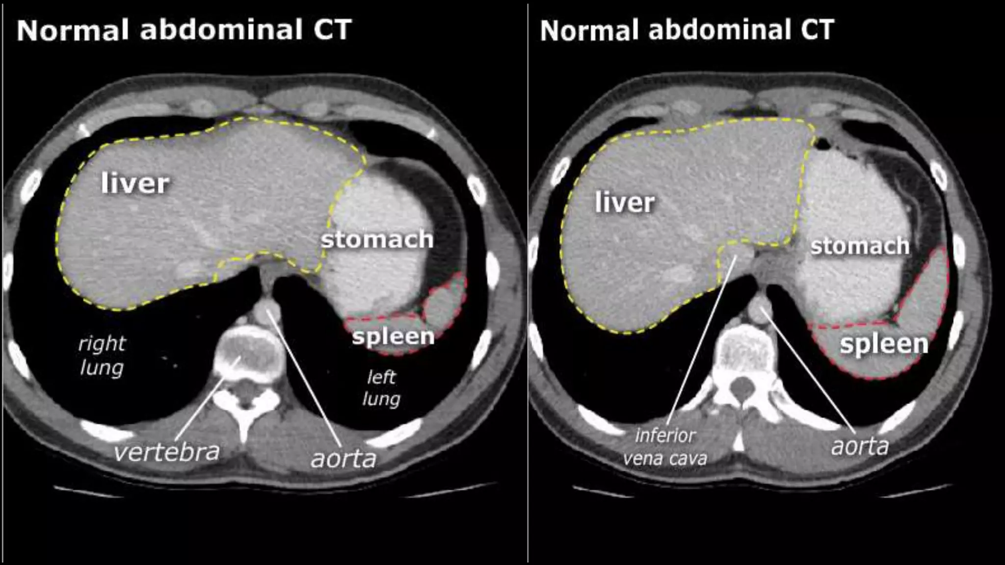 LIVER SEGMENT ANATOMY CT SCAN | PPTX | Digestive Disorders | Diseases ...