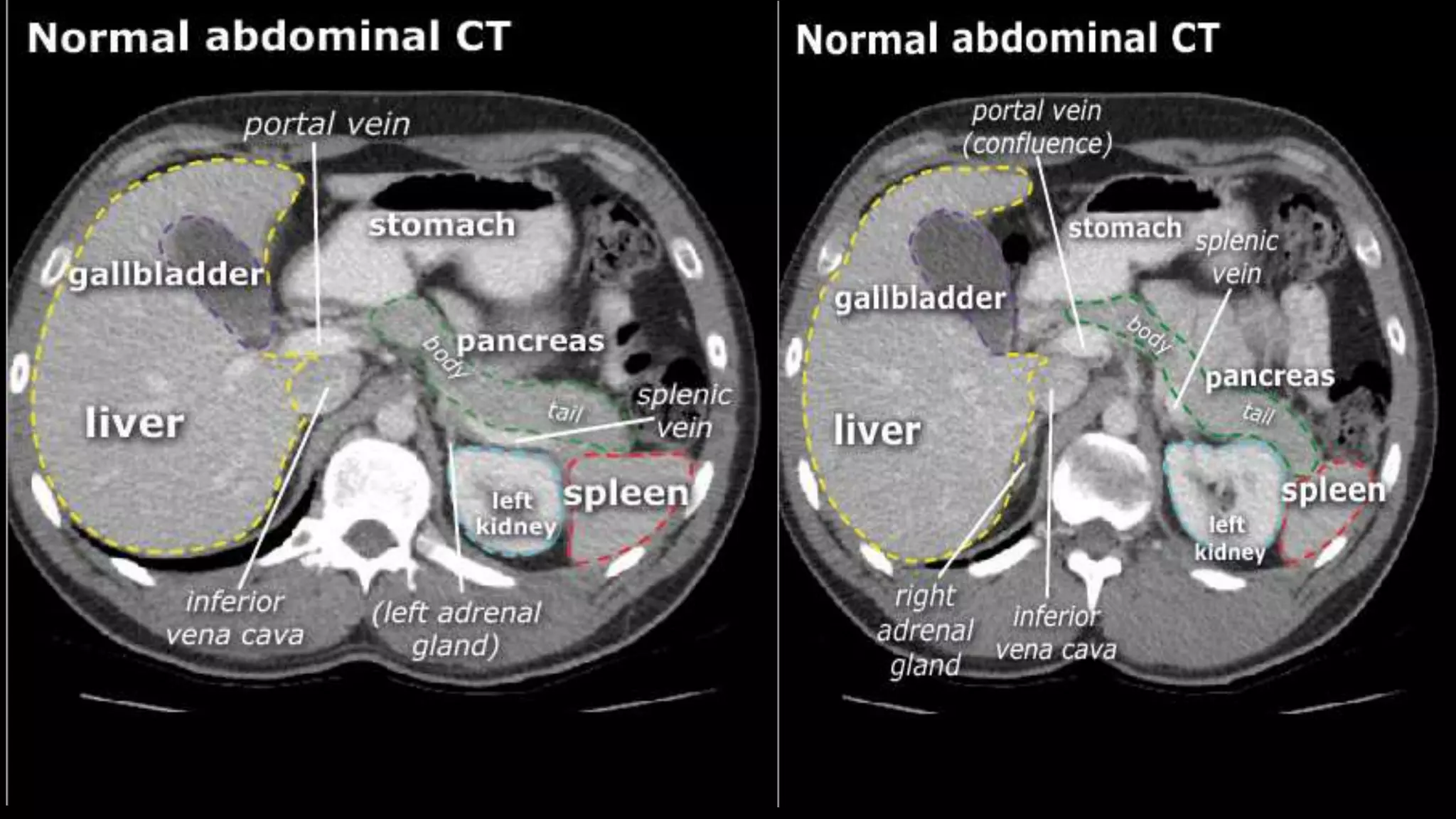 LIVER SEGMENT ANATOMY CT SCAN | PPTX | Digestive Disorders | Diseases ...