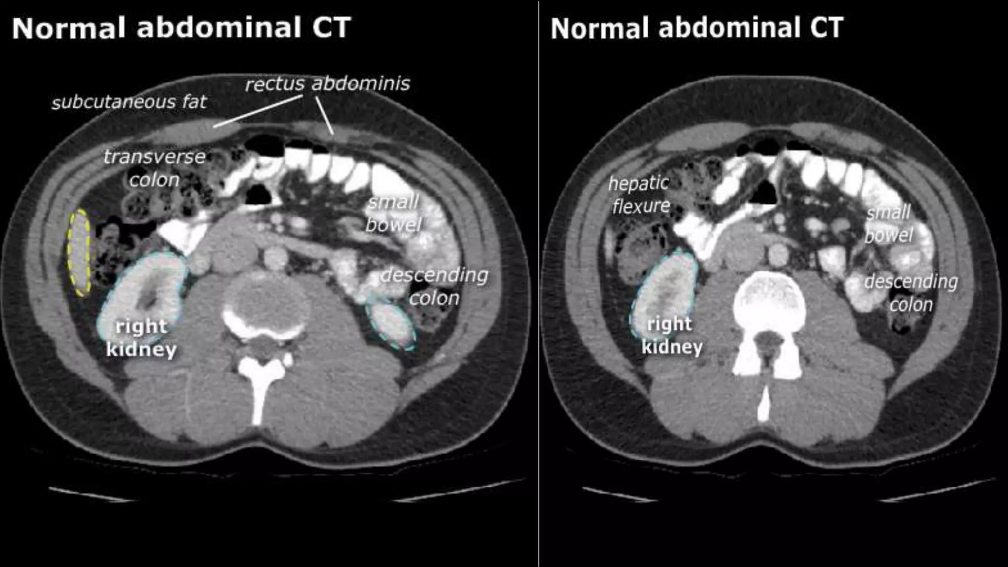 LIVER SEGMENT ANATOMY CT SCAN | PPTX