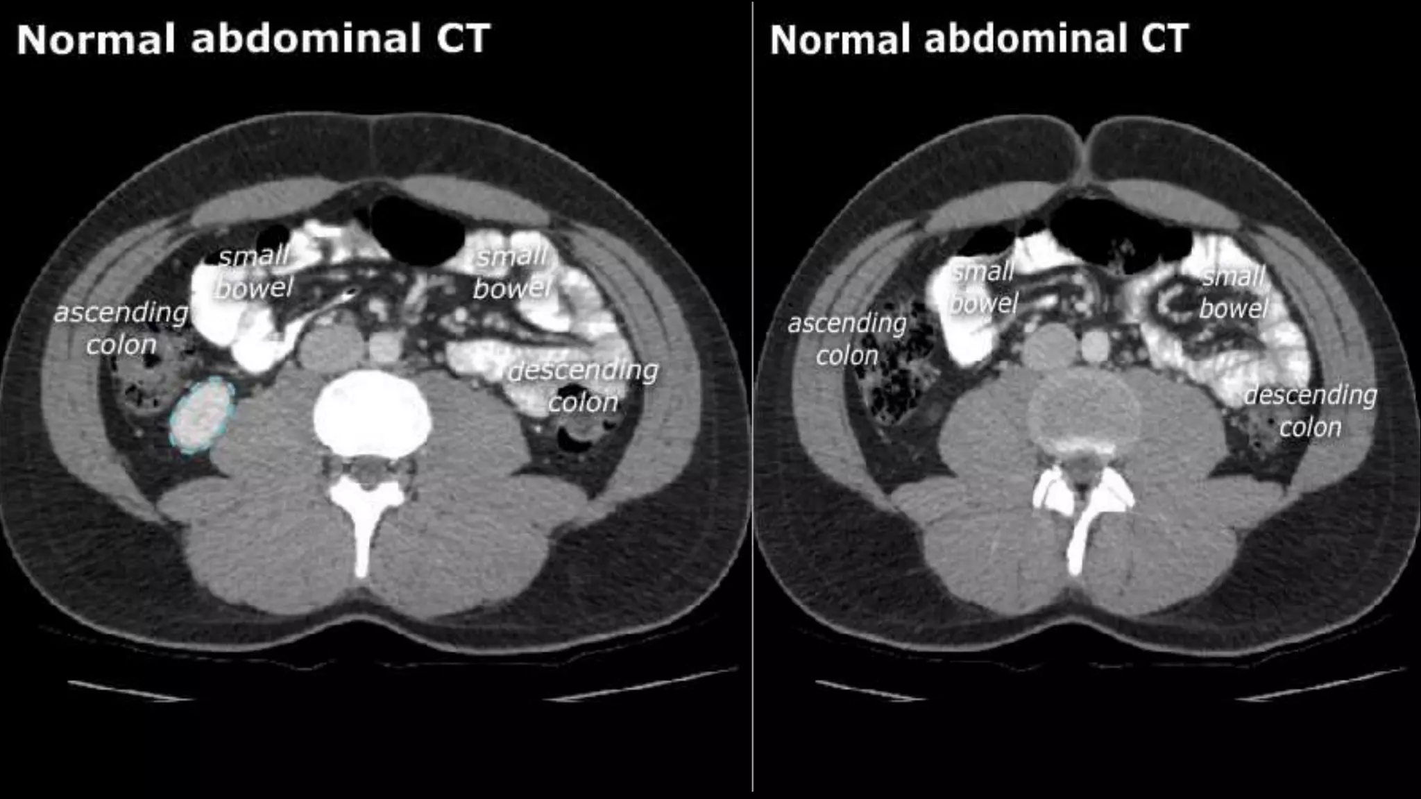 LIVER SEGMENT ANATOMY CT SCAN | PPTX | Digestive Disorders | Diseases ...