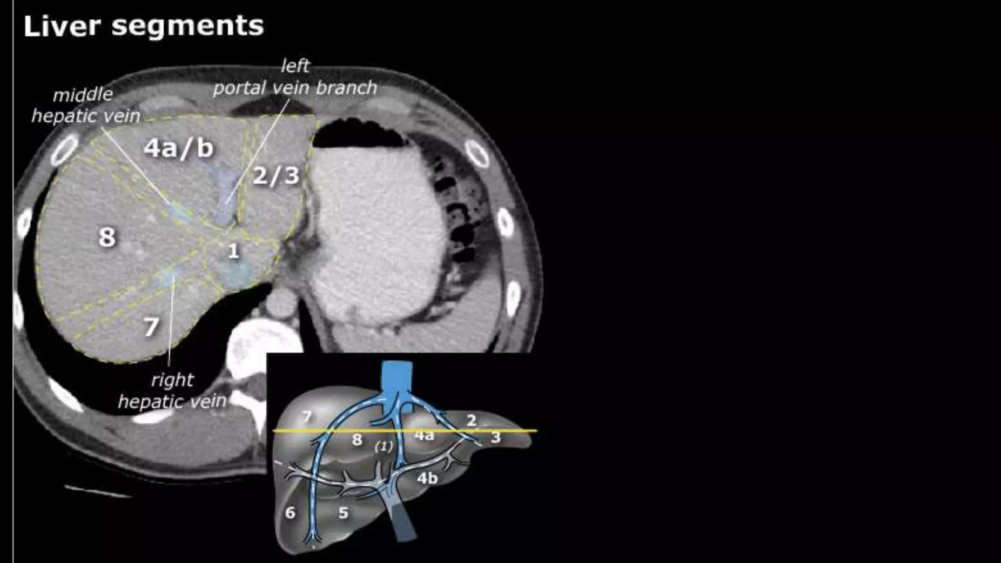 LIVER SEGMENT ANATOMY CT SCAN | PPTX