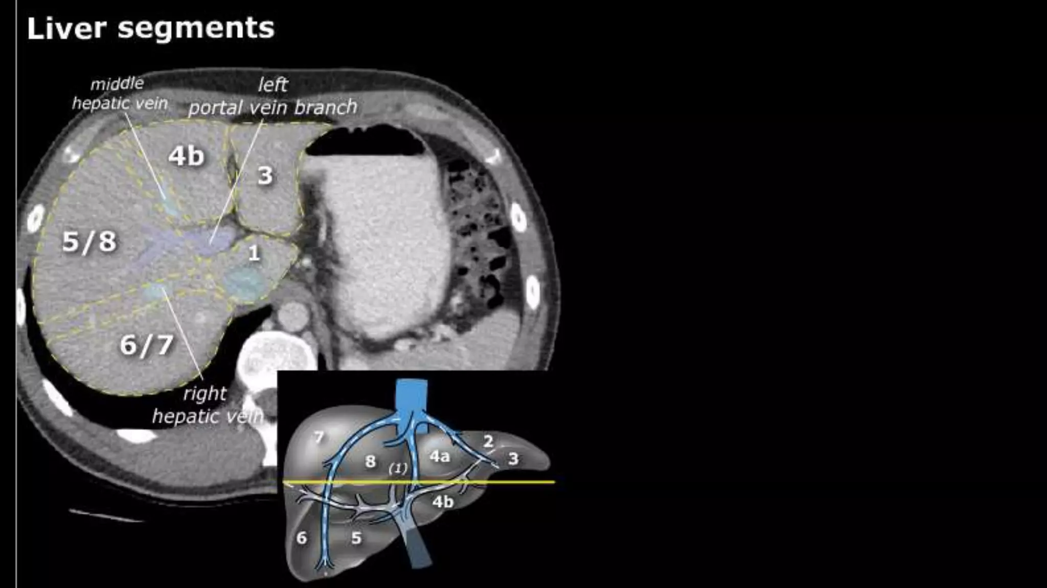 LIVER SEGMENT ANATOMY CT SCAN | PPTX