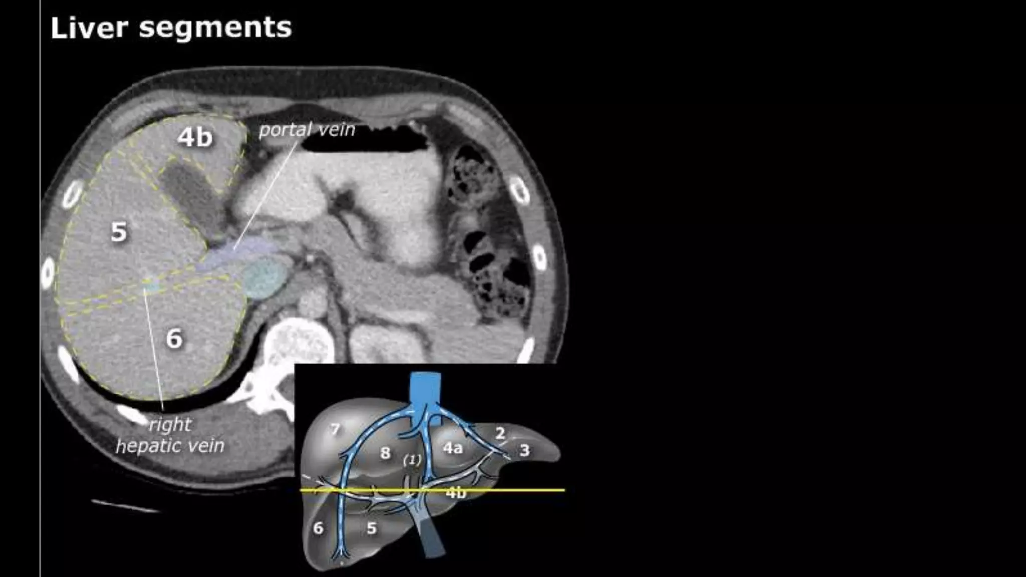 LIVER SEGMENT ANATOMY CT SCAN | PPTX