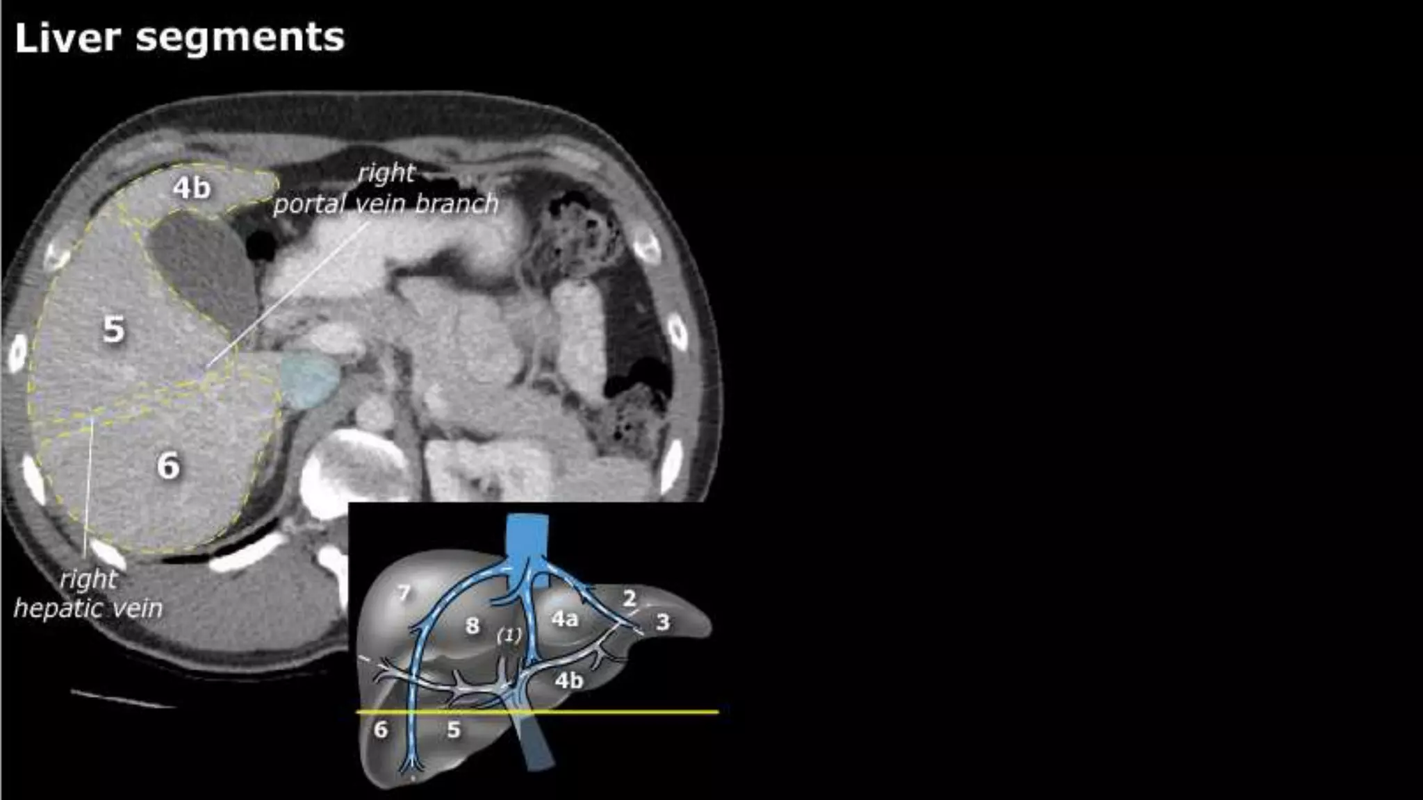 LIVER SEGMENT ANATOMY CT SCAN | PPTX
