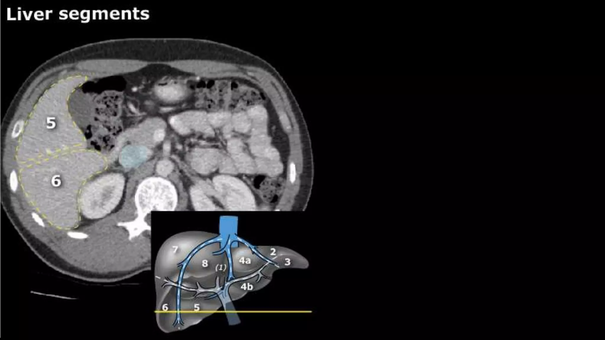 LIVER SEGMENT ANATOMY CT SCAN | PPTX | Digestive Disorders | Diseases ...