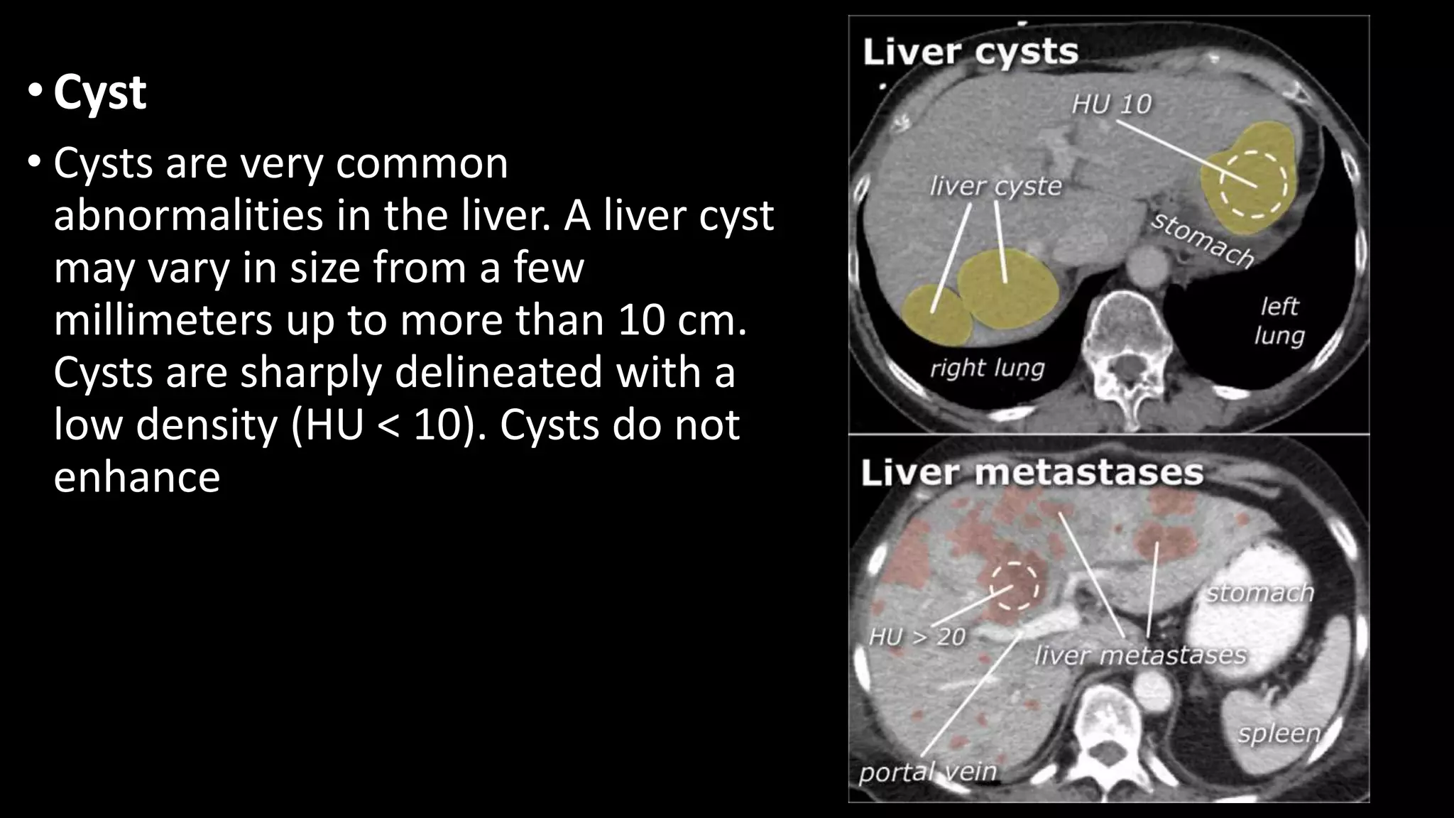 LIVER SEGMENT ANATOMY CT SCAN | PPTX