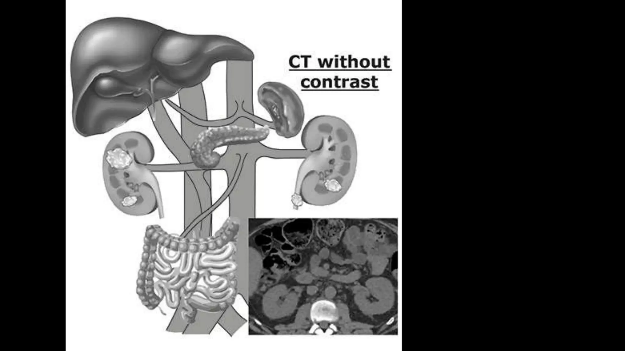 LIVER SEGMENT ANATOMY CT SCAN | PPTX | Digestive Disorders | Diseases ...
