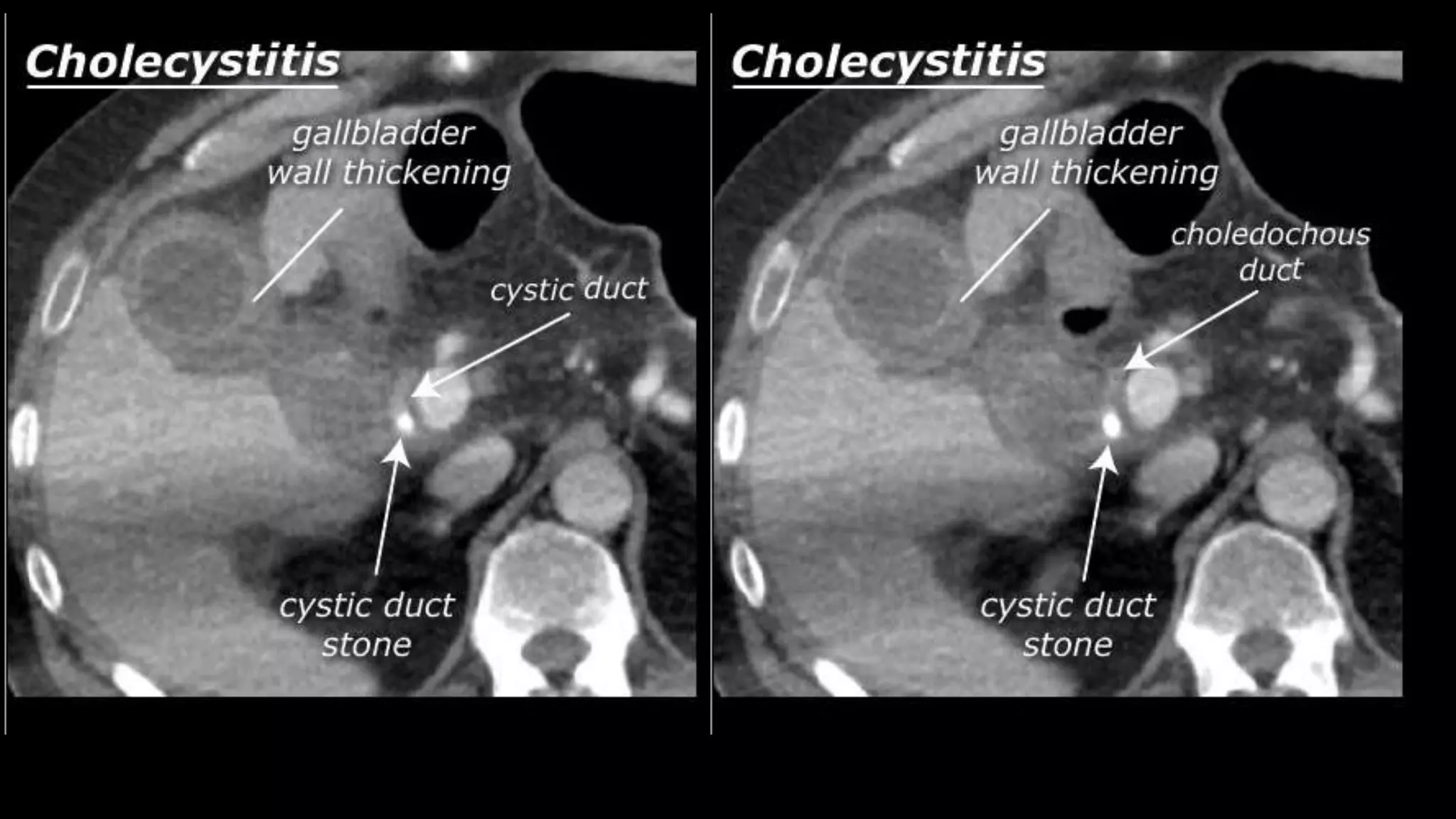 LIVER SEGMENT ANATOMY CT SCAN | PPTX