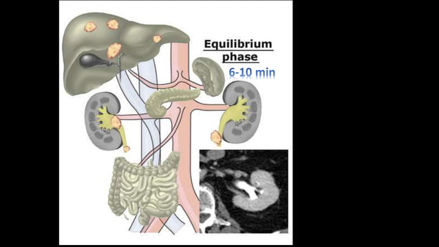 LIVER SEGMENT ANATOMY CT SCAN | PPTX | Digestive Disorders | Diseases ...