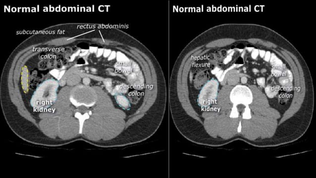 Liver Segmental Anatomy Ct Scan