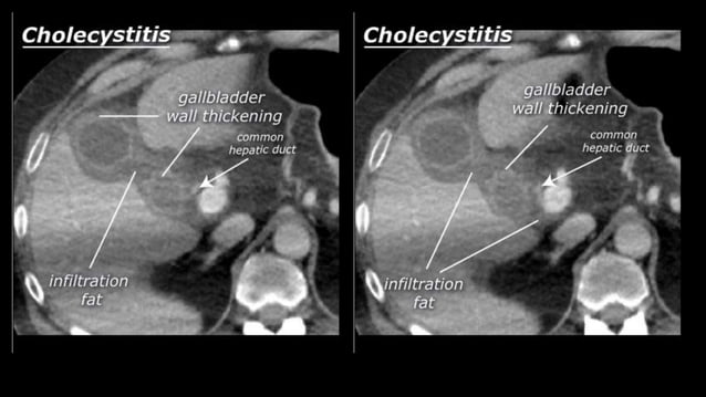 LIVER SEGMENT ANATOMY CT SCAN