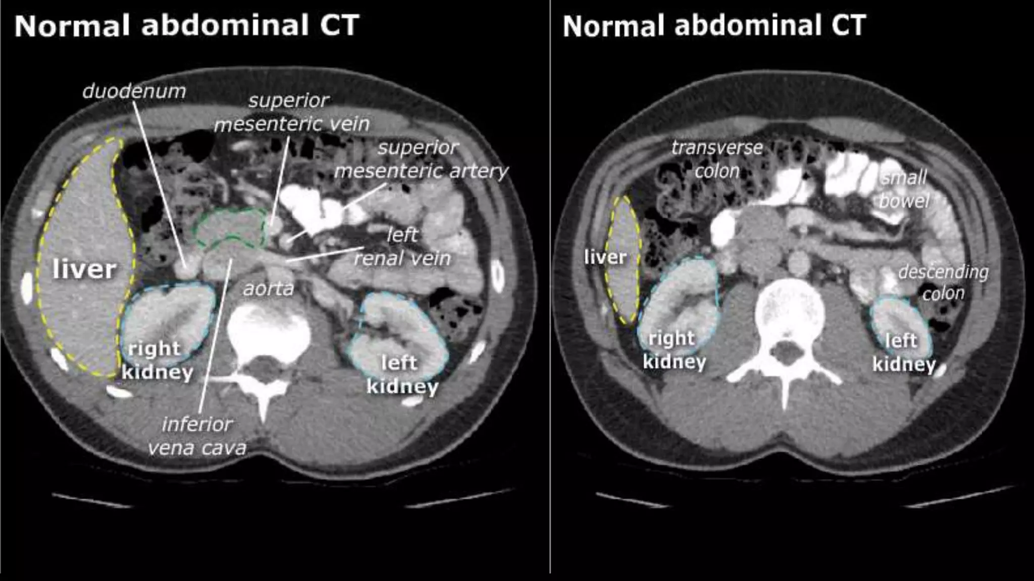 CT liver segments ANATOMY BIPHASI TRIPHASIC | PPTX