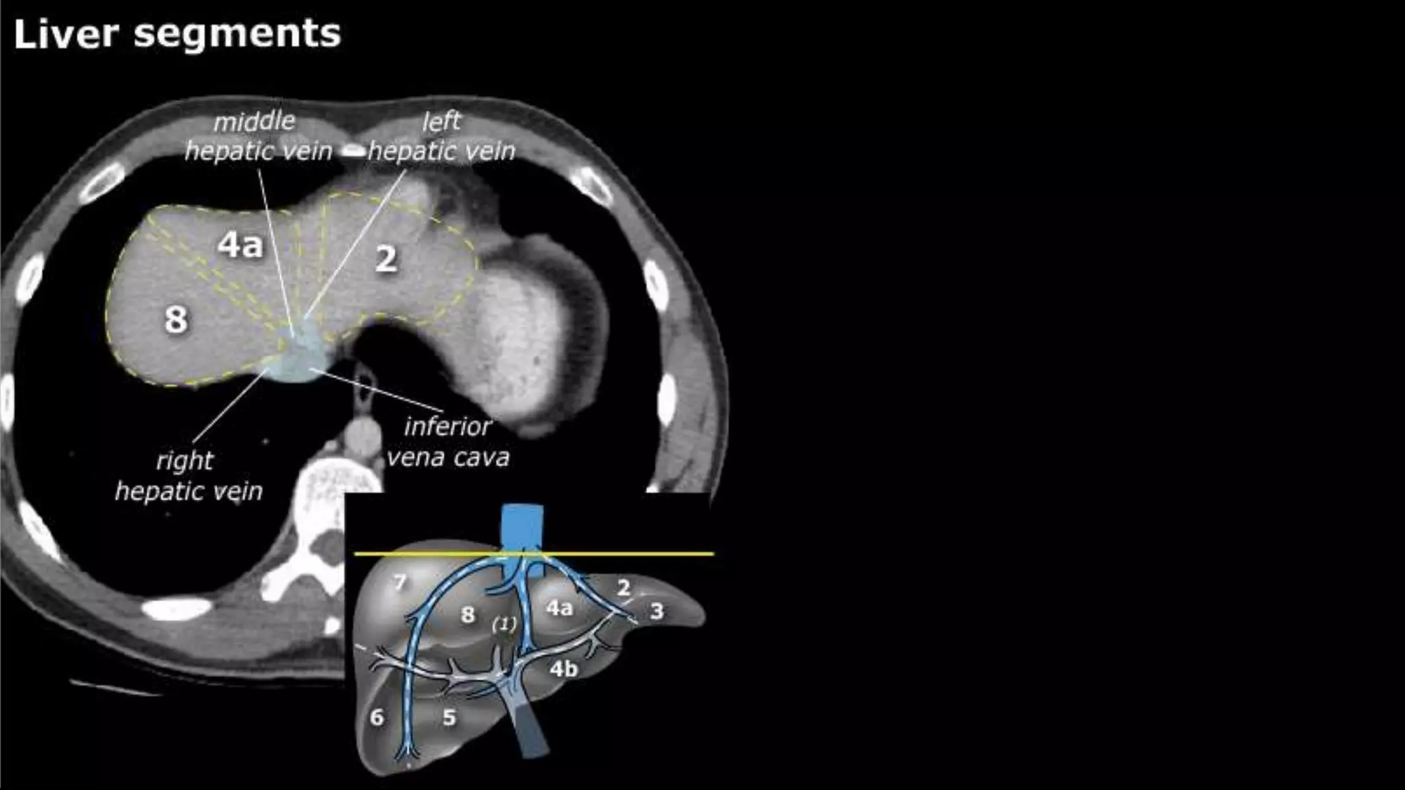 CT liver segments ANATOMY BIPHASI TRIPHASIC | PPTX