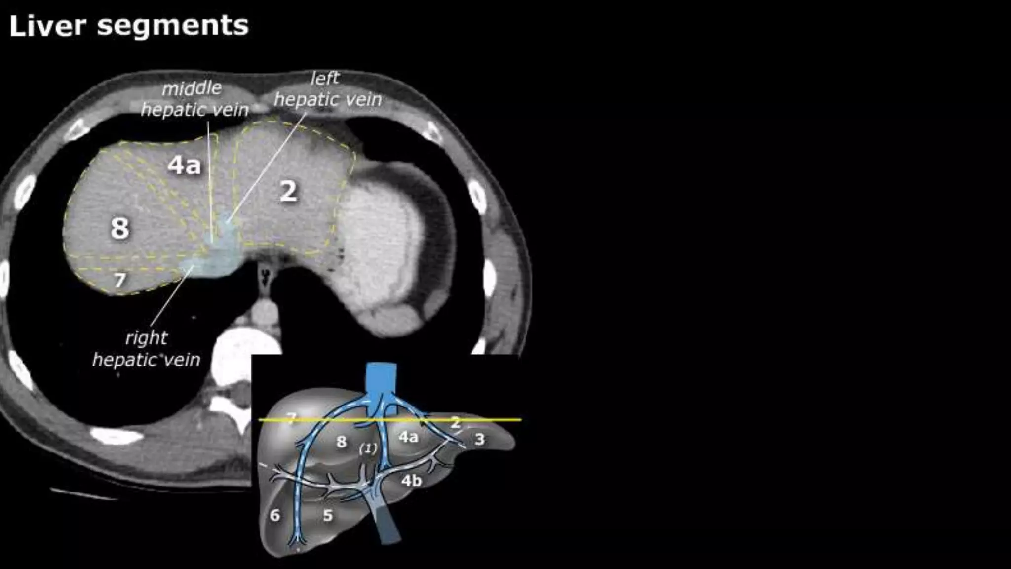 CT liver segments ANATOMY BIPHASI TRIPHASIC | PPTX