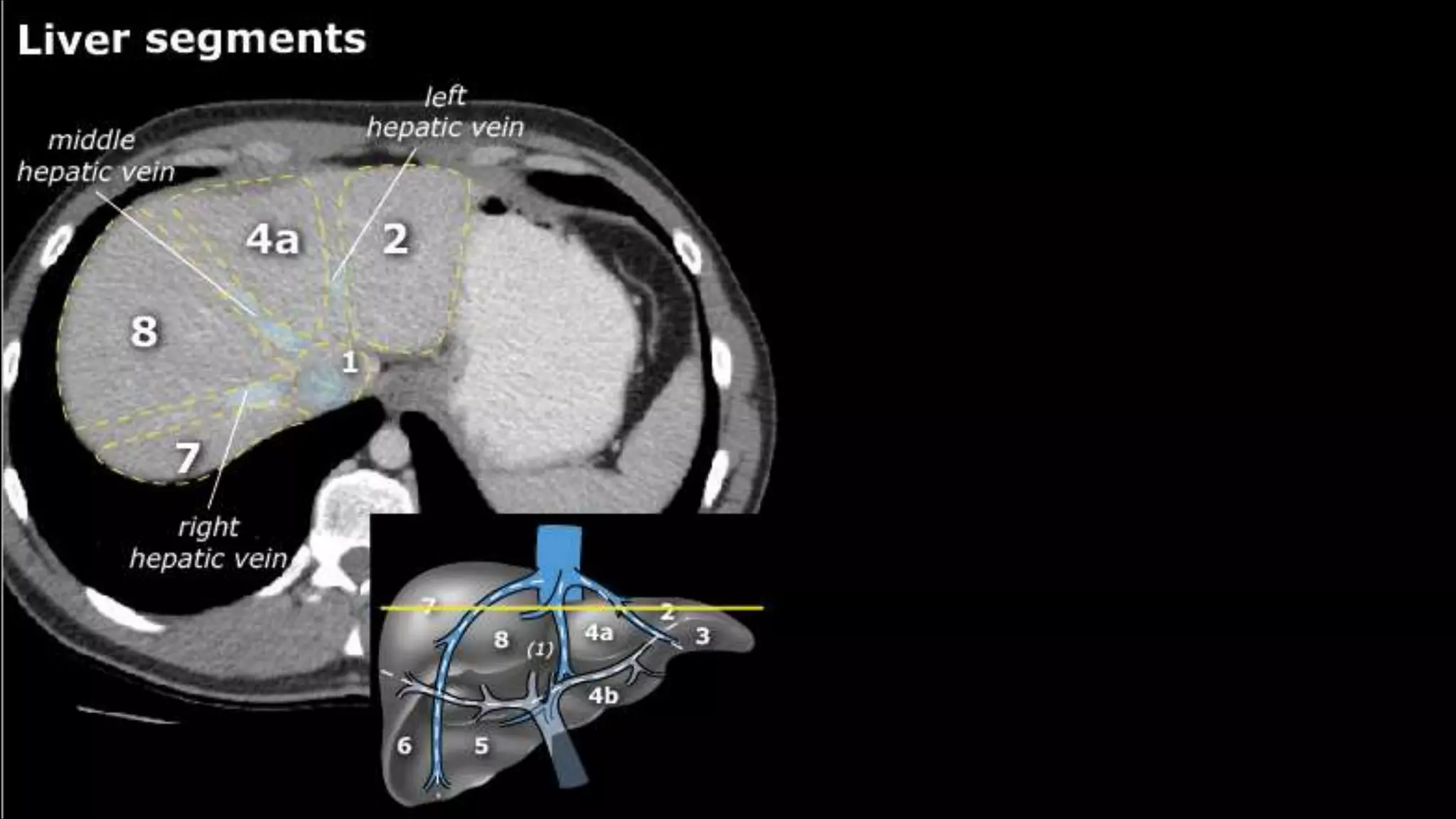 CT liver segments ANATOMY BIPHASI TRIPHASIC | PPTX