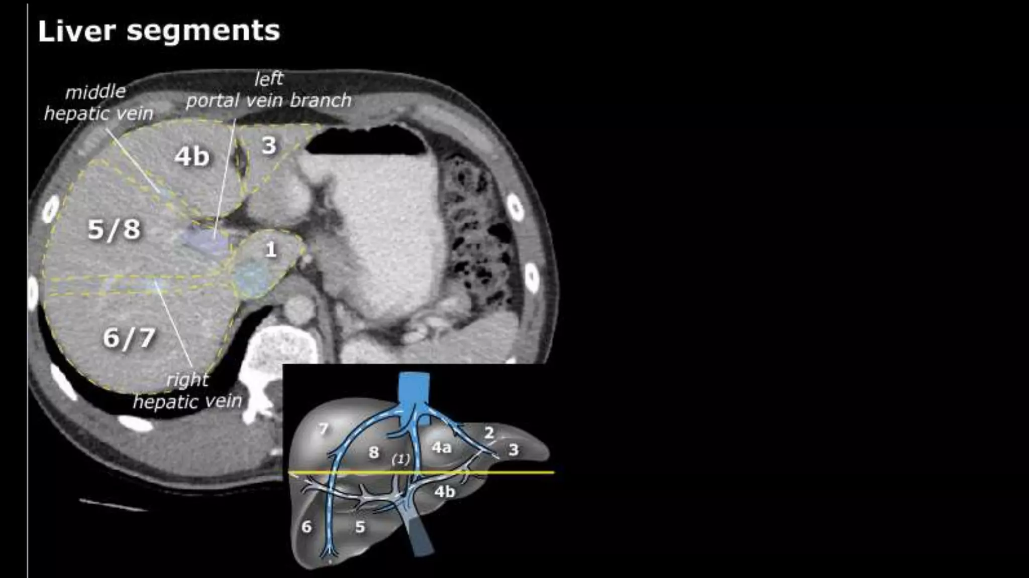 CT liver segments ANATOMY BIPHASI TRIPHASIC | PPTX