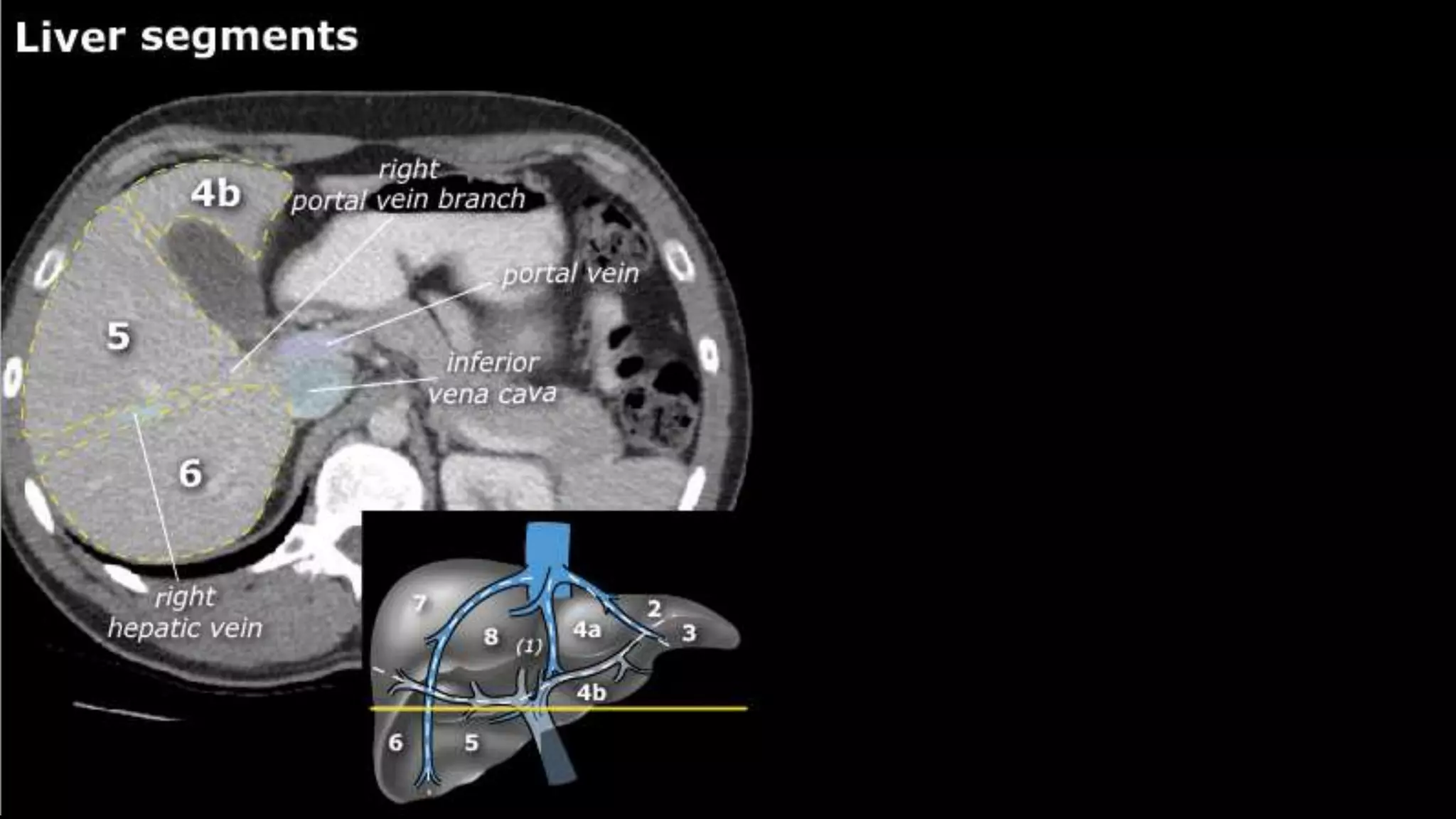 CT liver segments ANATOMY BIPHASI TRIPHASIC | PPTX