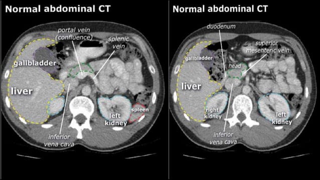 CT liver segments ANATOMY BIPHASI TRIPHASIC | PPTX
