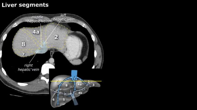 CT liver segments ANATOMY BIPHASI TRIPHASIC | PPTX