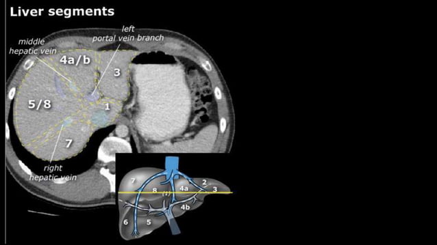 CT liver segments ANATOMY BIPHASI TRIPHASIC | PPTX