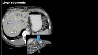 CT liver segments ANATOMY BIPHASI TRIPHASIC | PPTX