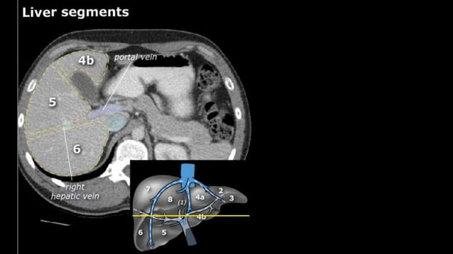 CT liver segments ANATOMY BIPHASI TRIPHASIC | PPTX
