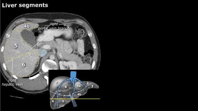 CT liver segments ANATOMY BIPHASI TRIPHASIC | PPTX