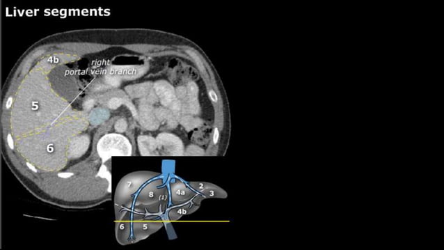 CT liver segments ANATOMY BIPHASI TRIPHASIC | PPTX