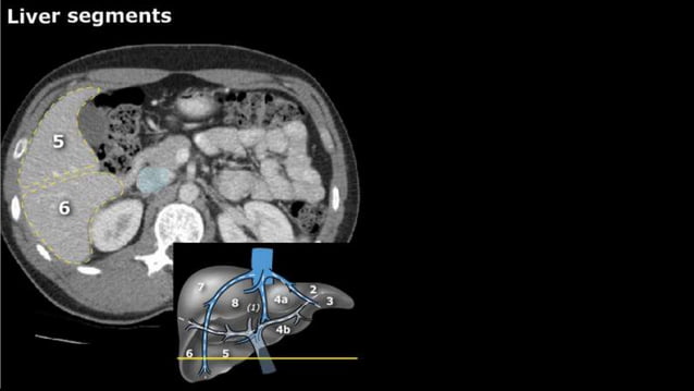 CT liver segments ANATOMY BIPHASI TRIPHASIC | PPTX