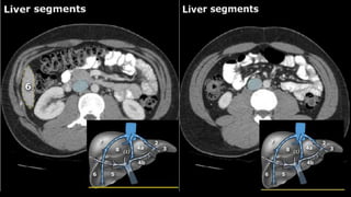 CT liver segments ANATOMY BIPHASI TRIPHASIC | PPTX