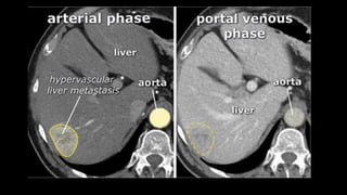 CT liver segments ANATOMY BIPHASI TRIPHASIC | PPTX