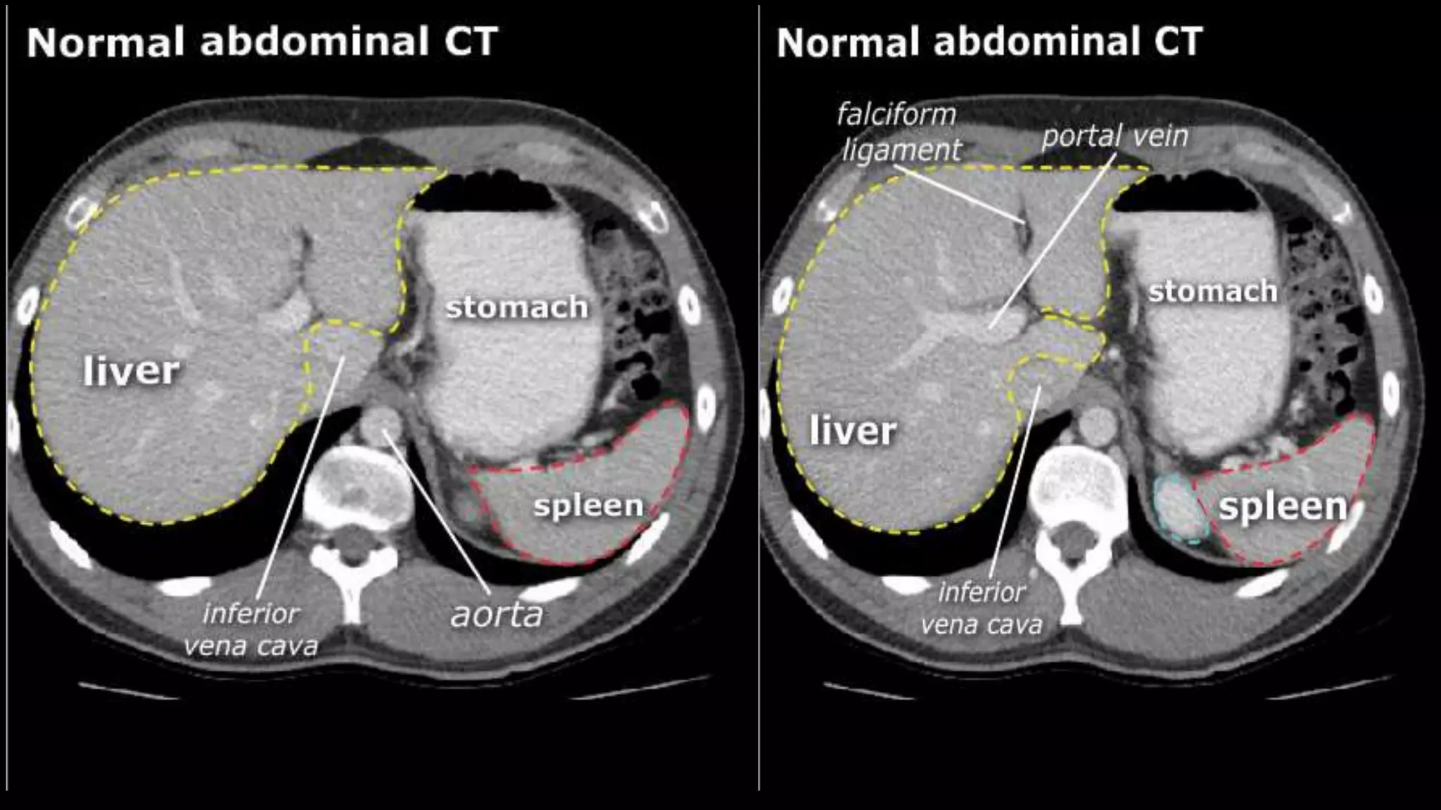 Liver segments Radiopaedia.com1