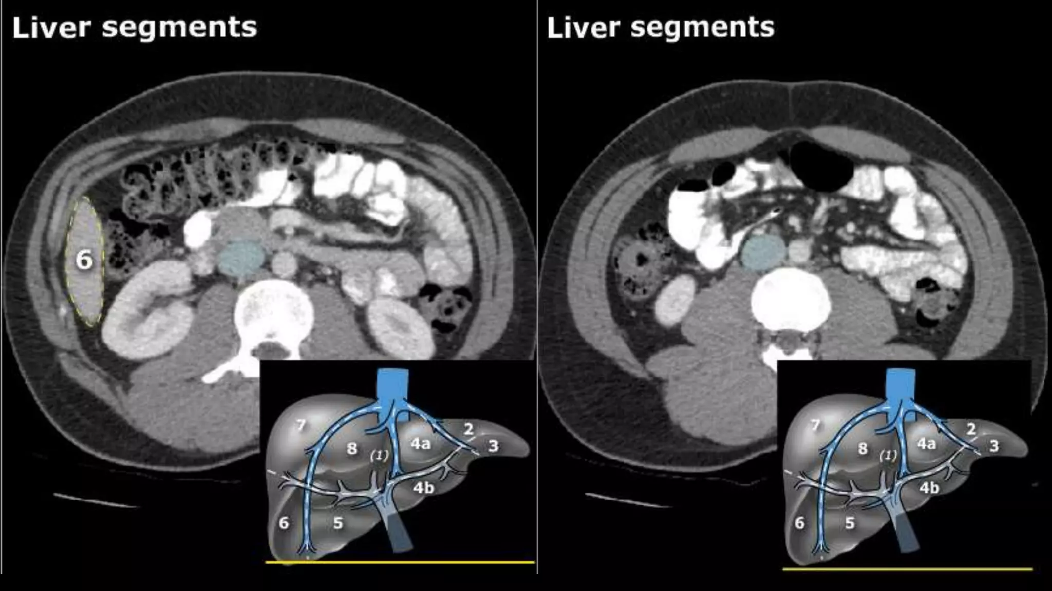 Liver segments Radiopaedia.com1