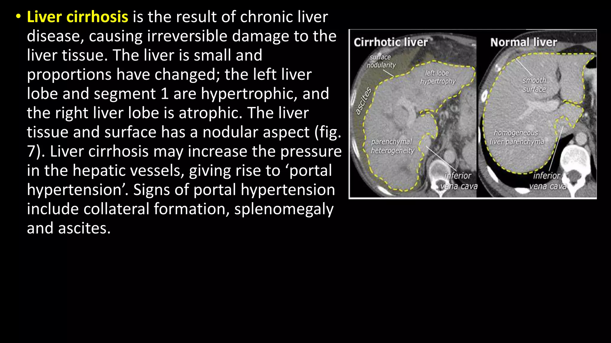 Liver segments Radiopaedia.com1